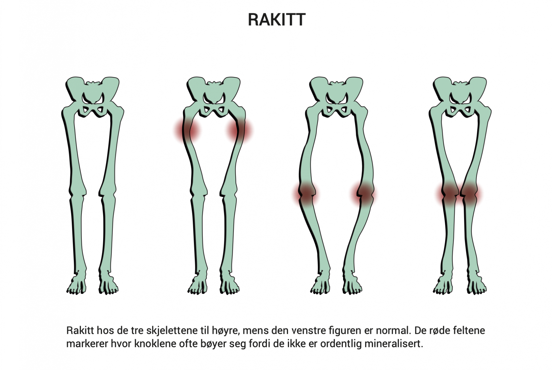 Hva er rakitt? | Bodymarkers